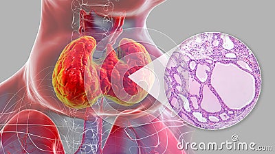 Endemic Goiter, 3D Illustration And Light Micrograph | CartoonDealer ...