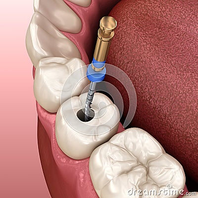 Endodontic Root Canal Treatment Process. Medically Accurate Tooth ...