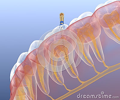 Endodontic Root Canal Treatment Process. Medically Accurate Tooth 3D ...