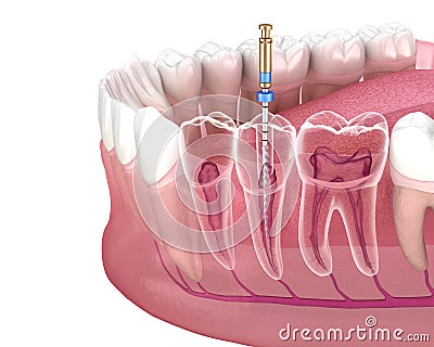 Endodontic Root Canal Treatment Process. Medically Accurate Tooth 3D ...