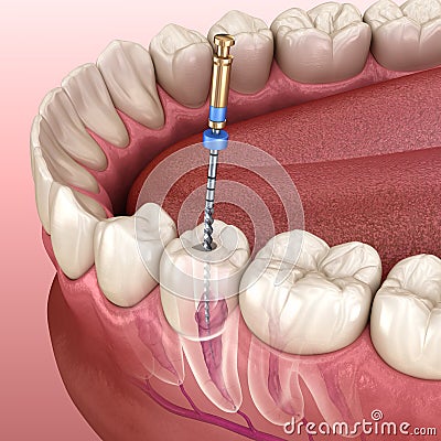 Endodontic Root Canal Treatment Process. Medically Accurate Tooth 3D ...