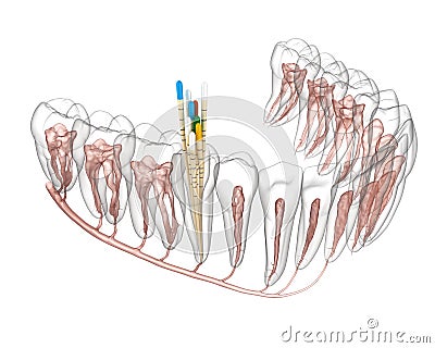 Endodontic Root Canal Treatment Process. Medically Accurate Tooth 3D ...