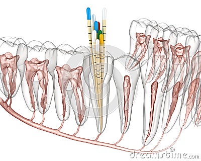 Endodontic Root Canal Treatment Process. Medically Accurate Tooth 3D ...