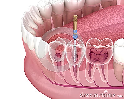 Endodontic Root Canal Treatment Process. Medically Accurate Tooth 3D ...