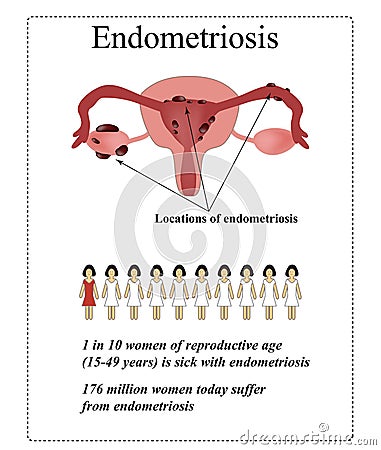 Endometriosis. Endometrial Cysts. The Endometrium. Statistics ...
