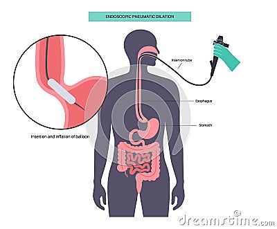 Endoscopic Pneumatic Dilation Cartoon Vector | CartoonDealer.com #290185607