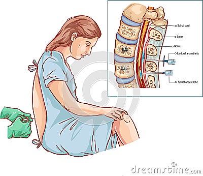 Epidural Nerve Block Injection Illustration Cartoon Vector ...