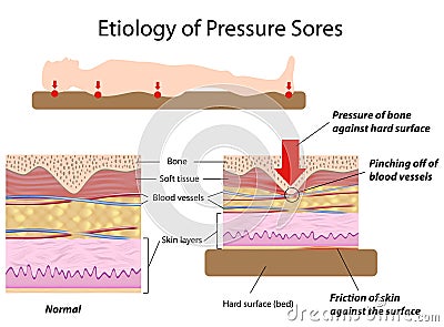 Etiology Of Pressure Sores Stock Image - Image: 22146781