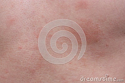 Example Dermatological Skin Allergy Stock Photo - Image: 39690365