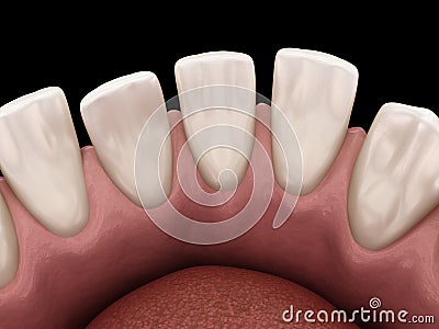 Excessive Spacing Between Teeth. Dental 3D Illustration Concept ...