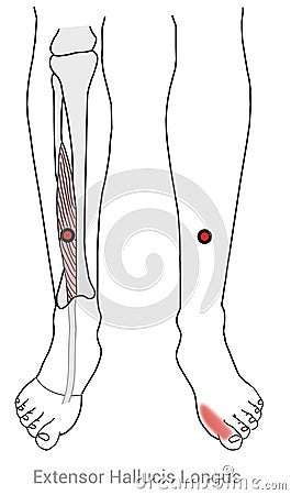 Extensor Hallucis Longus Myofascial Trigger Points Can Cause Big Toe ...