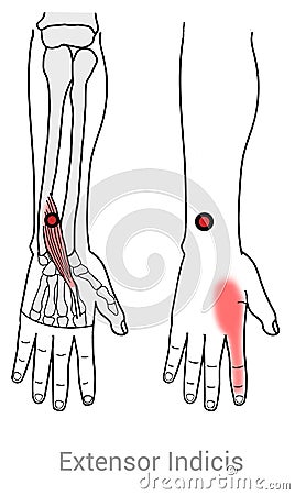 Extensor Indicis Muscle Myofascial Trigger Points Can Cause Index ...