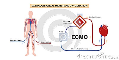 Extracorporeal Membrane Oxygenation Cartoon Vector | CartoonDealer.com ...