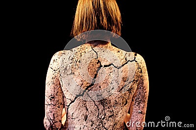 Extreme Dry Skin Stock Image - Image: 17373931