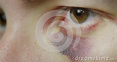 The Eye of a Man with a Bruise and Abrasions Stock Video - Video of ...