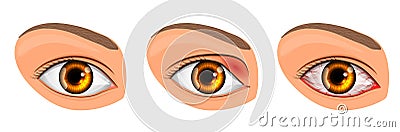 Eye Suffering From Conjunctivitis And Styes Cartoon Vector ...