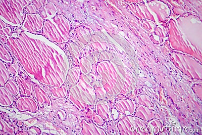 Fibrous Thyroiditis, Light Micrograph Royalty-Free Stock Photo ...