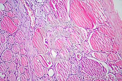 Fibrous Thyroiditis, Light Micrograph Stock Image | CartoonDealer.com ...