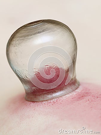 Fire Cupping Treatment To Cup Sb Therapy Woman Stock Images - Image ...