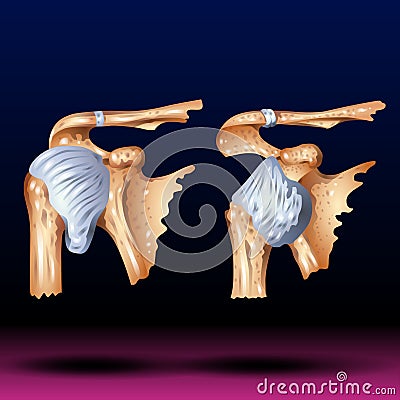 Shoulder Dislocation - Human Skeleton, Bone Anatomy, Artwork ...