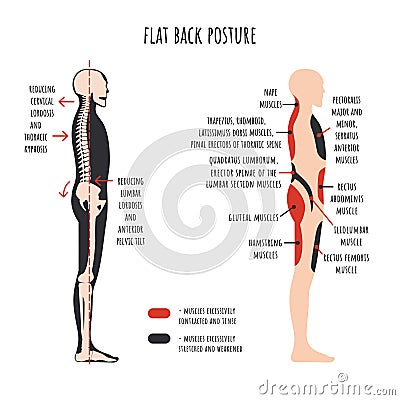 Flat Back Posture. The Side View Shows Characteristic Decrease Natural ...