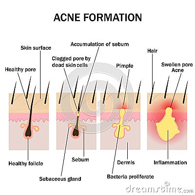 Formation Of Acne Vector Illustration | CartoonDealer.com #65571568