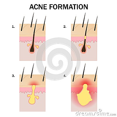 Formation Of Acne Stock Vector - Image: 68333411