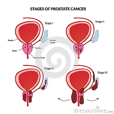 Four Stages Of Prostate Cancer Vector Illustration | CartoonDealer.com ...