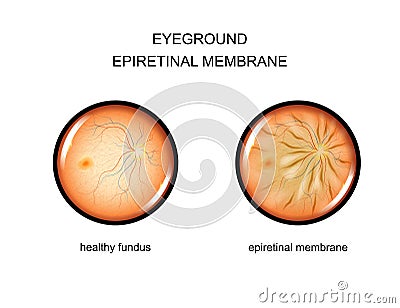 Fundus. Epiretinal Membrane Cartoon Vector | CartoonDealer.com #116017103