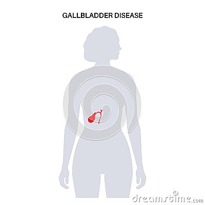 Gallbladder Disease Poster Cartoon Vector | CartoonDealer.com #252465405