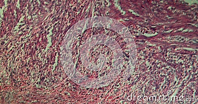 Gallbladder Necrosis Tissue Stock Footage - Video of magnification ...