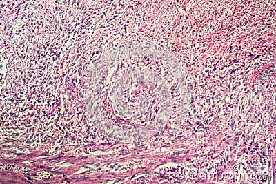 Gallbladder Necrosis Tissue Under The Microscope Stock Photo ...