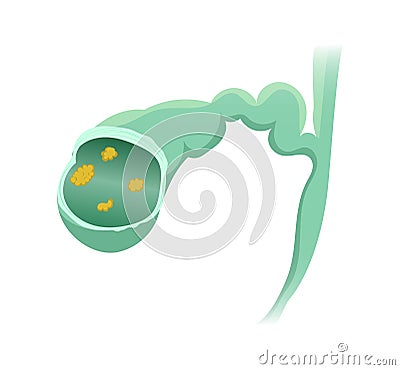 Gallbladder Polyps. Cholesterol Deposits Inside The Gallblader Cartoon ...
