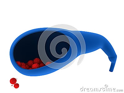 Gallbladder Stones Stock Illustration | CartoonDealer.com #12499357