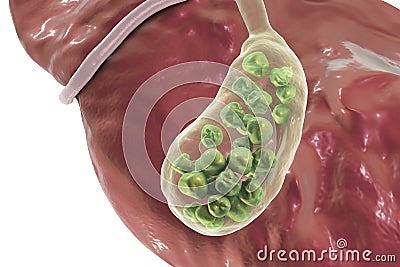 Gallstones, Illustration Showing Bottom View Of Liver And Gallbladder ...