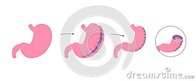 Gastric Plication Flat Infographics. The Explanation Picture Of Stomach ...
