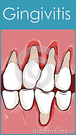 Gingivitis. Cartoon Vector | CartoonDealer.com #87591461