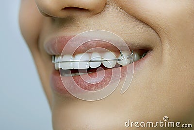 Girl With Retainer On Teeth Royalty Free Stock Photo - Image: 33262035