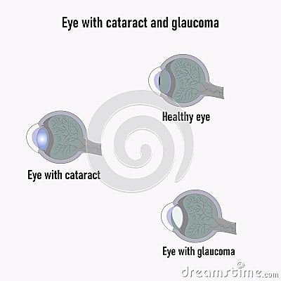 Glaucoma Eye. Development Of Glaucoma. The Structure Of The Eye ...
