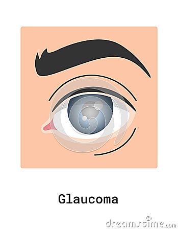 Glaucoma Human Eye Disease Cartoon Vector | CartoonDealer.com #276072623