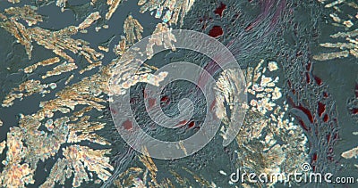 Gout tissue with crystals stock video. Video of science - 206143865