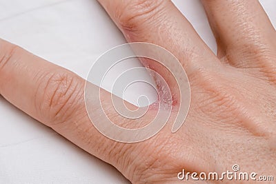 Hand With Interdigital Dermatitis, Dyshidrotic Eczema On Hand Close Up ...