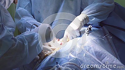 The Surgeon Making an Incision on the Abdomen Stock Video - Video of ...