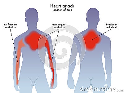 Heart Attack Pain Location Stock Illustration - Image: 70298230