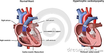 Heart Problem Hypertrophic Cardiomyopathy Cartoon Vector ...