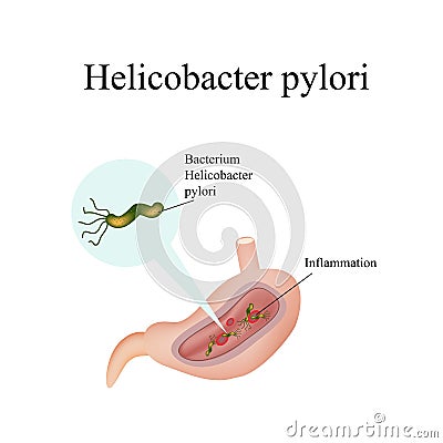 Helicobacter Pylori In The Stomach. Infographics. Vector Illustration ...