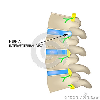 A Hernia Of The Intervertebral Disc. Vector Illustration On Isolated ...