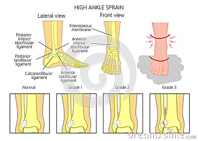 High Ankle Sprain Vector Illustration | CartoonDealer.com #80085204