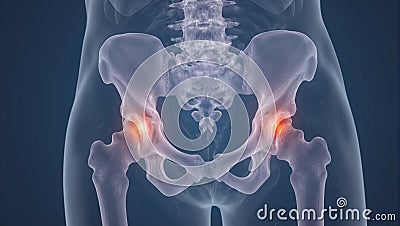 Hip Joint With Osteoarthritis Bone Spurs Detailed Anatomy Educational ...