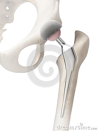 Hip Replacement Royalty-Free Illustration | CartoonDealer.com #30724935